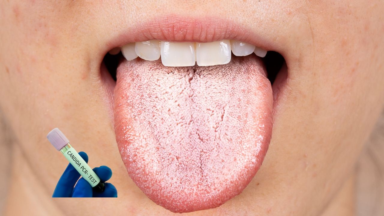 Natural Ways to Address Candida Overgrowth with Functional Nutrition ...
